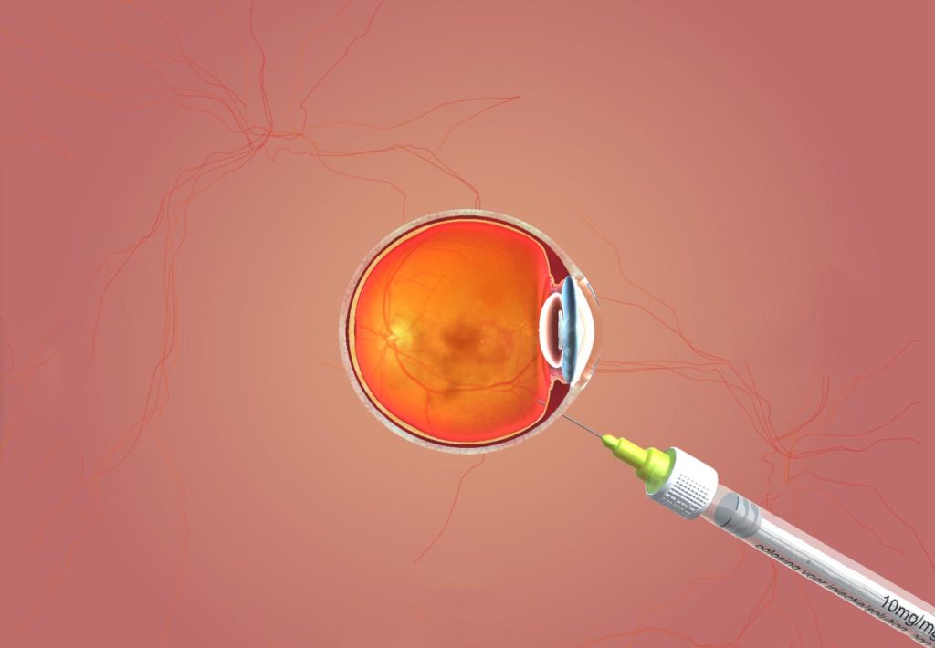 IVT (les injections intravitréennes) - Ophtalmo Vitré